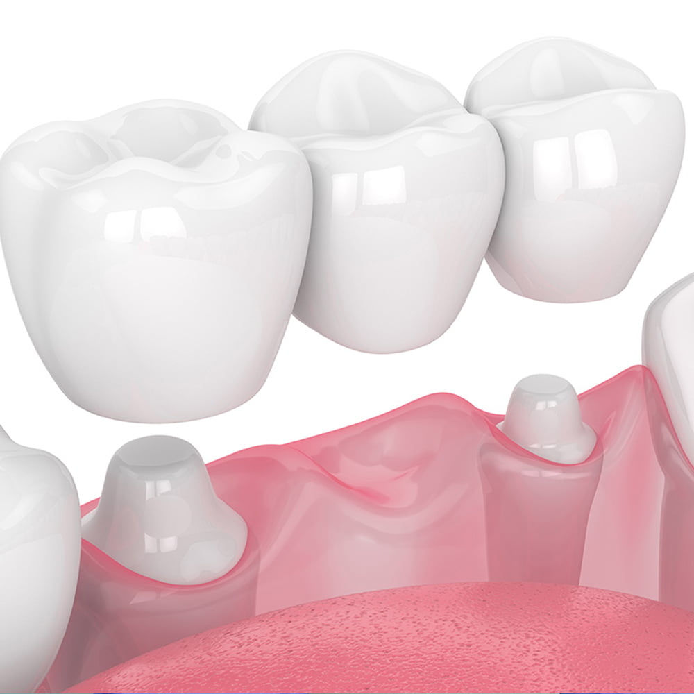 Protesi Fissa: Ripristina i Denti con Precisione- Studio Dentistico Manzoni